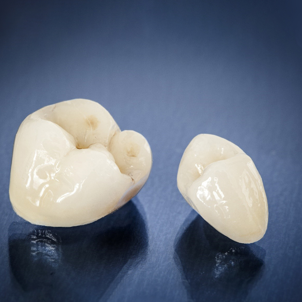 Couronne dentaire, Bridge dentaire et Dentier à Alger